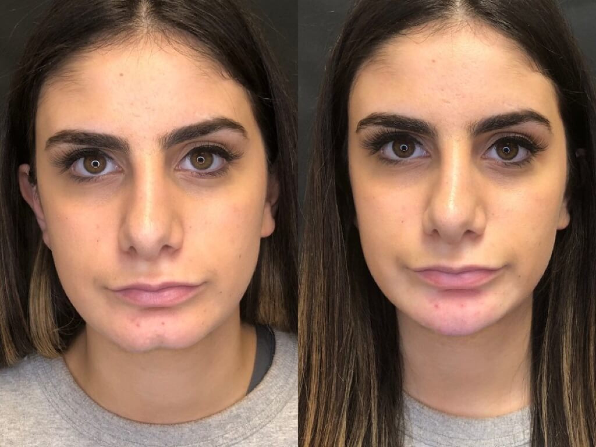 How to Get Rid of Butt Chin 5 Proven Way? - Robustalive