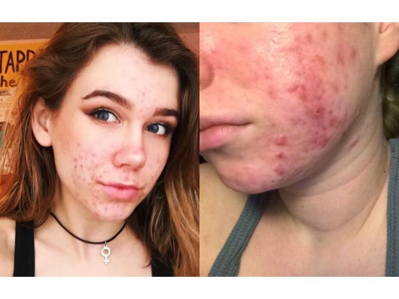 Doxycycline Ruined My Life: Unveiling the Devastating Effects