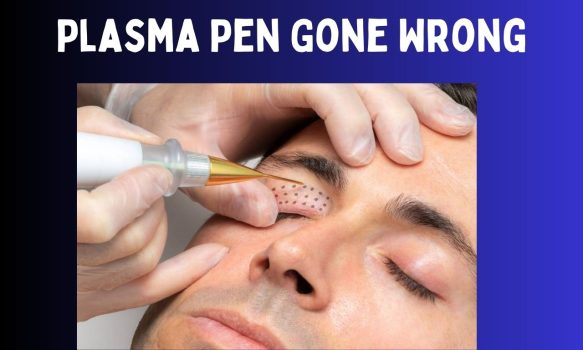 Plasma Pen Gone Wrong - Problems, Causes & Solutions - Robustalive