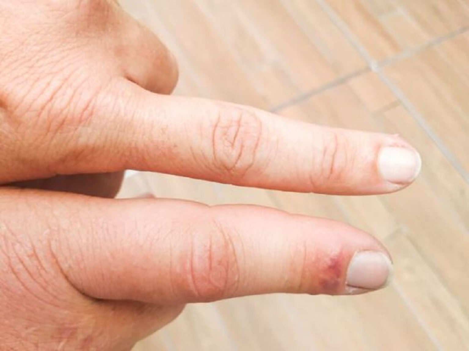 Skin Between Thumb and Index Finger: What Causes Itching, Swelling ...