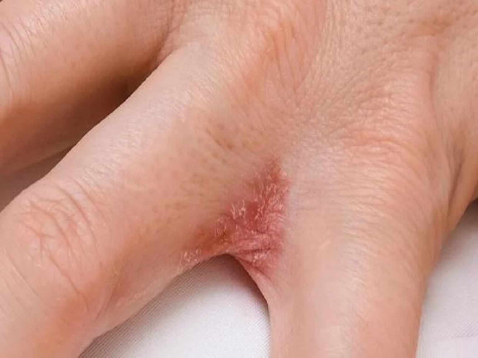 Skin Between Thumb and Index Finger: What Causes Itching, Swelling ...