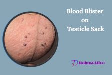 Blood Blister on Testicle Sack - Causes, Symptoms, and Treatment