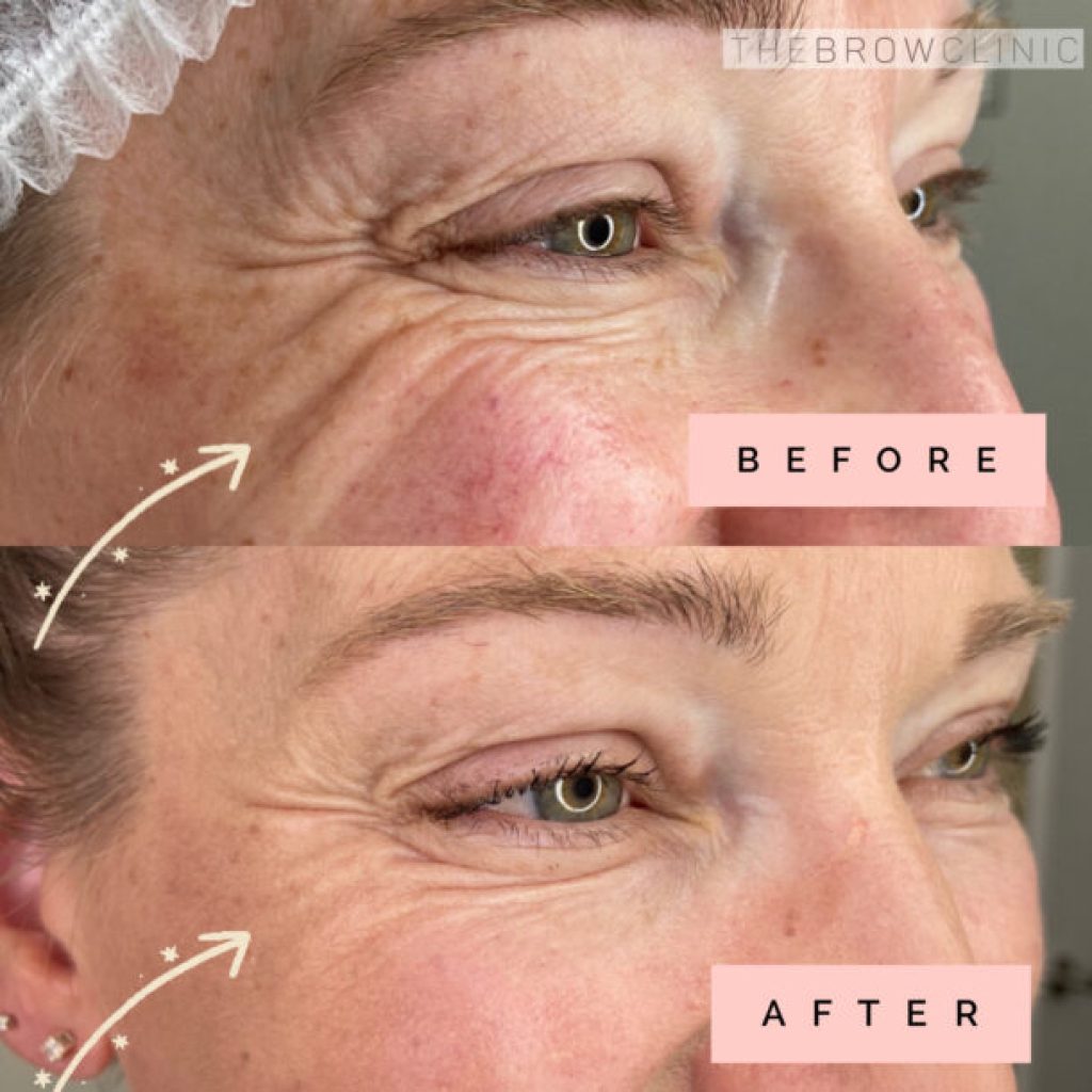 Plasma Pen Fibroblast: Boosting Skin Rejuvenation Naturally